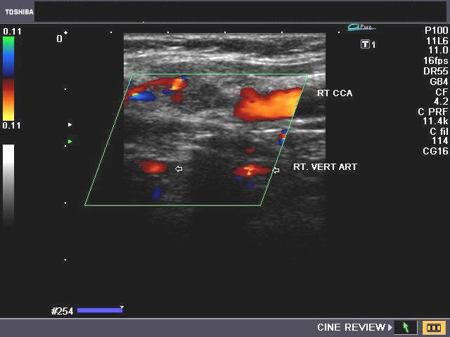 RadiologySpirit: Ultrasound and Color Doppler imaging of vertebral artery:
