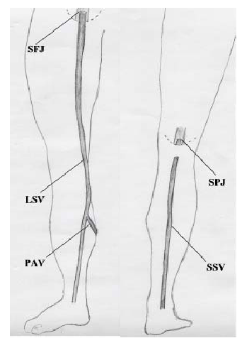 RadiologySpirit: surgical anatomy of saphenous veins