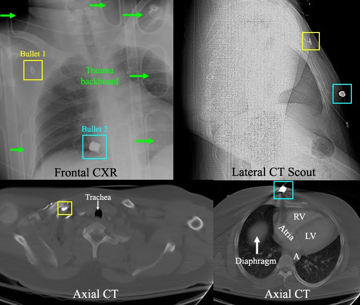 RadiologySpirit: Bullets and Shrapnel in the Chest on Plain Film and CT ...