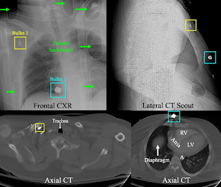 RadiologySpirit: Bullets and Shrapnel in the Chest on Plain Film and CT ...
