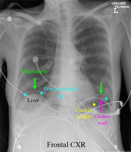RadiologySpirit: Pneumoperitoneum