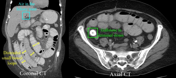 RadiologySpirit: Gallstone Ileus on CT Scans