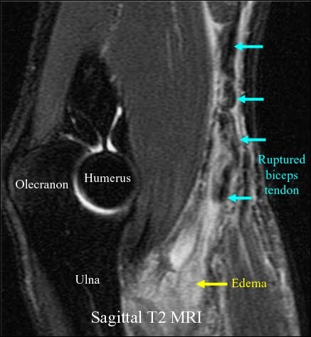 Distal Bicep Tendon Mri