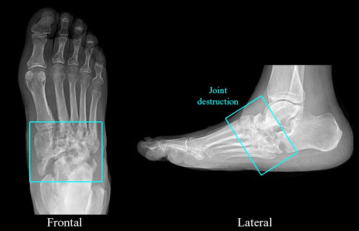 RadiologySpirit: Neuropathic Arthritis / Charcot Foot