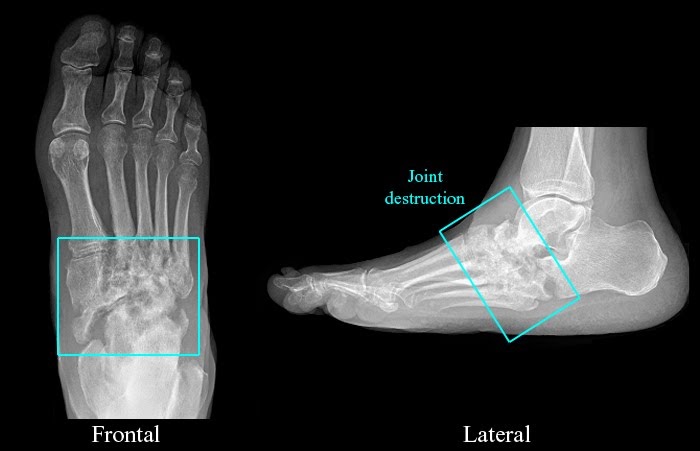 RadiologySpirit: Neuropathic Arthritis / Charcot Foot