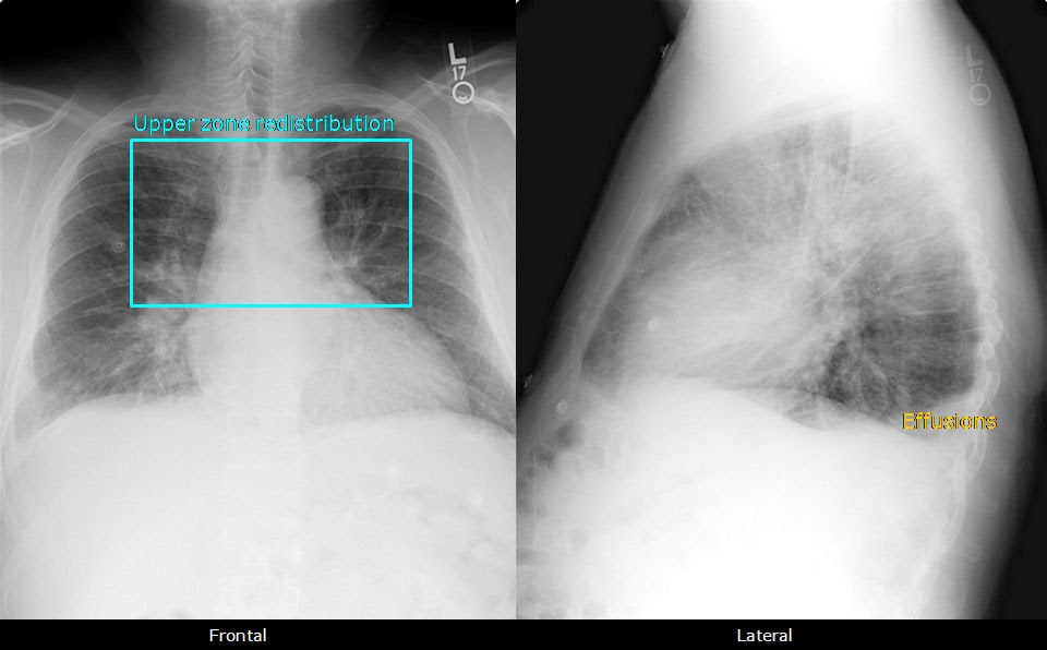 RadiologySpirit: CHF with upper zone redistribution