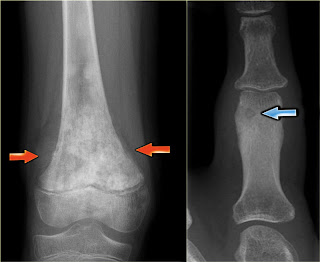 RadiologySpirit: osteoid matrix