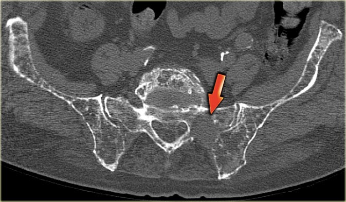 RadiologySpirit: multiple myeloma