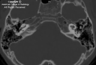 RadiologySpirit: mondini malformation