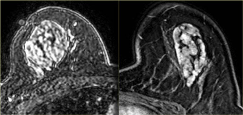 RadiologySpirit: breast,hamartoma