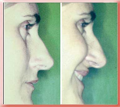 The drooping nasal tip – drooping tip of the nose