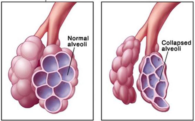 M Tanri Arrizasyifaa-Fisiologi Alveolus - Gina & Husna