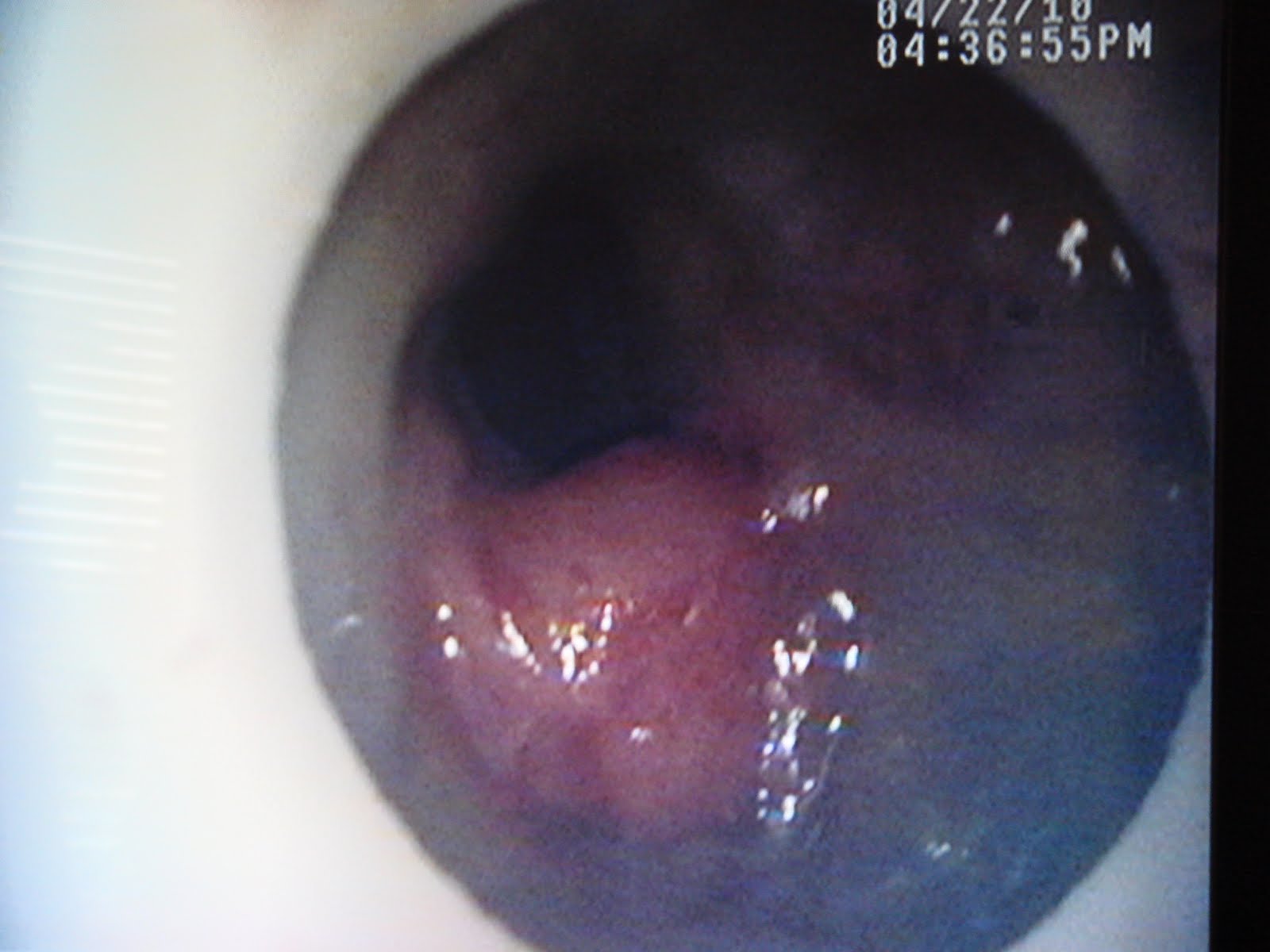 FREMITUS: Airway Obstruction Secondary to Growing Granulomatous Tissue ...