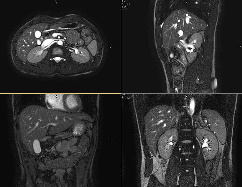 Kidney Mri Images