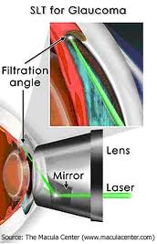Irv Arons' Journal: Selective Laser Trabeculoplasty (SLT) Technology ...