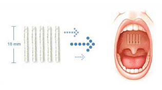 Mt. Scott ENT @ Sleep Medicine: Coblation Soft Palate Treatment ...