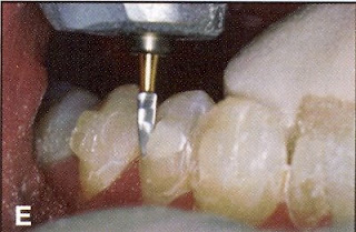 Highlands Ranch Orthodontist, Dr. Paul Rocke: A Simple Technique for ...