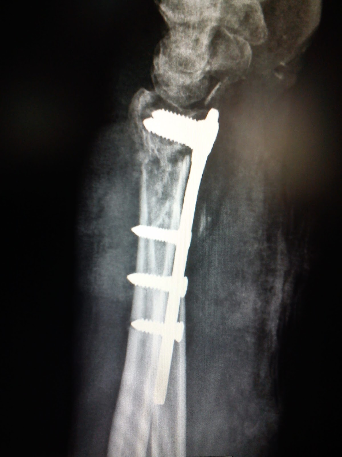 orthopaedics update: Darrach's Procedure ,locking volar plate , bone graft