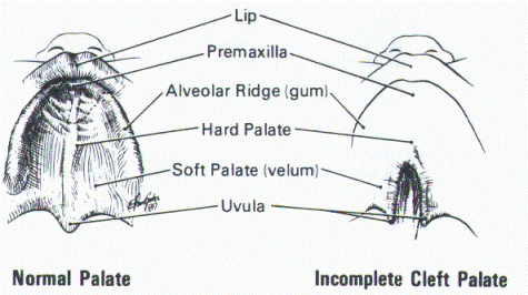 Cleft Palate