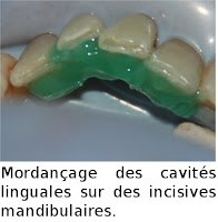 Elsodent fabriquant de produits dentaires: Gel de mordançage G-ETCH