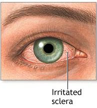 Whatever: Irritated Sclera
