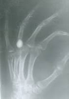 Patologias e Movimentos: Condromas