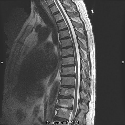 mri procedures and pathology: Thoracic Stenosis