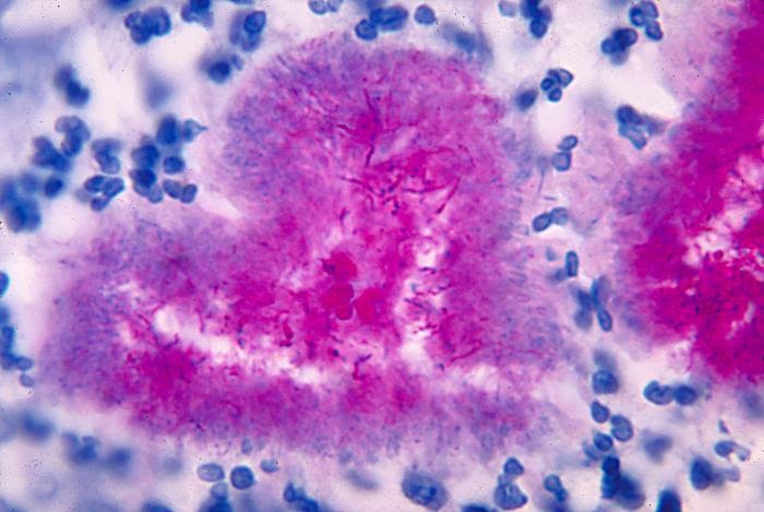 Enroque de ciencia: Nocardia asteroides