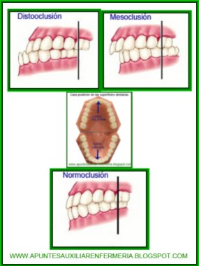 Tipos de Oclusión ~ Auxiliar de Odontología