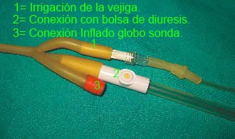 Tipos de Sondas Vesicales. | APUNTES AUXILIAR ENFERMERIA