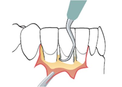 TERAPIA DE ACCESO Y VISIBILIDAD CX PERIODONTAL