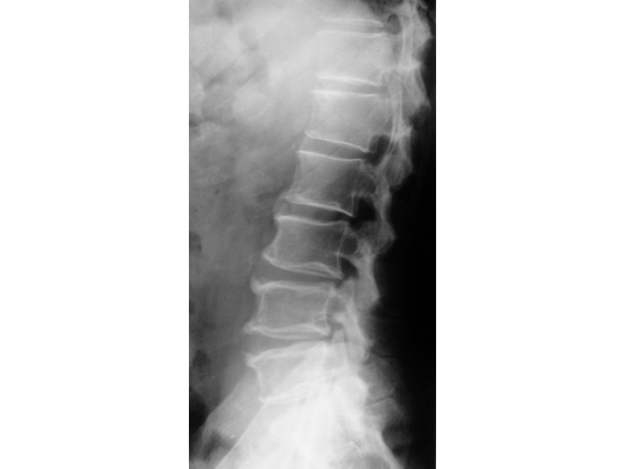 santé à la portée: Arthrose lombaire : radiologie du rachis