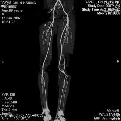 Days of a vascular surgeon in Taiwan: case: FP bypass using Distaflo graft