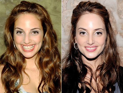 Celebrity Cosmetic Surgery: Alexa Ray Joel - Rhinoplasty