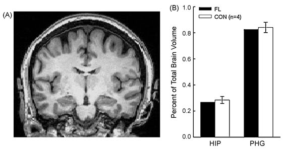 The Neurocritic: The Unique Case of “50 First Dates” Amnesia