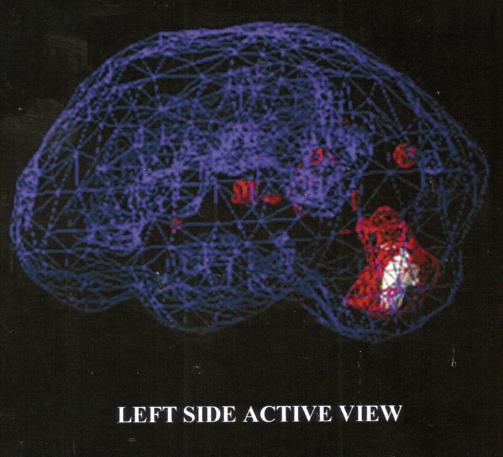 Escape from Depression: Chapter 13: My Brain Scans; Inside Active View