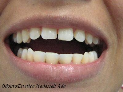 Clareamento Dent Rio - Tel: 3936-8037: Como se junta dentes separados ...