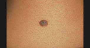KONSTANTIN: Nevus Pigmentosus, Apa Itu?