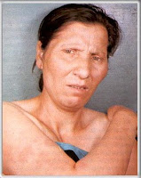 MYCOBACTERIUM.: TIPO DE LEPRA.