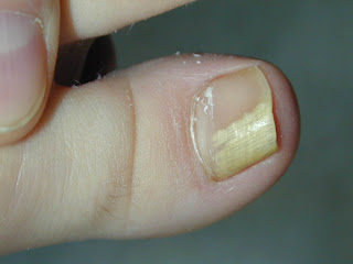 KLAUDYA NAILS: UNGHII BOLNAVE
