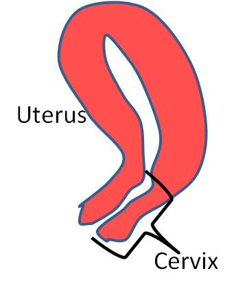 Stenosis: Stenosis Cervix