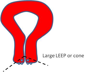 The AFA Blog: Cervical Stenosis from a Cone or LEEP