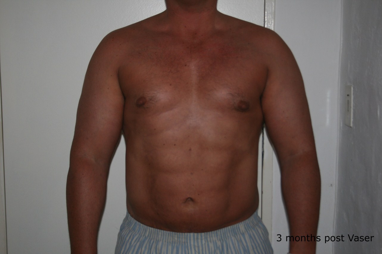 Vaser Liposelection in South Africa: 3 months post Vaser Hi-Def