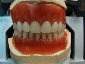 Prótesis Total 2 nivel AALD: Prótesis Total