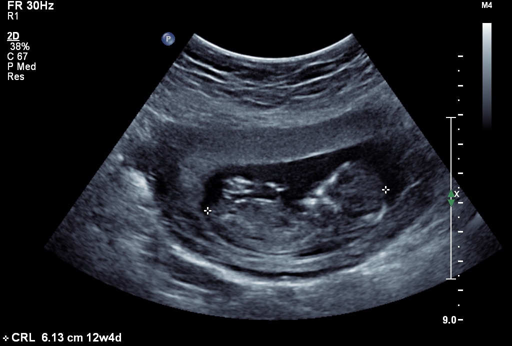 Butterfly Dreams: 12 Week NT Scan