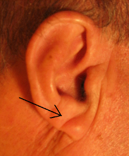 Natural Wellness: Diagonal Earlobe Crease