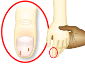 Tirthankar Online: Selected Images on Infective Endocarditis