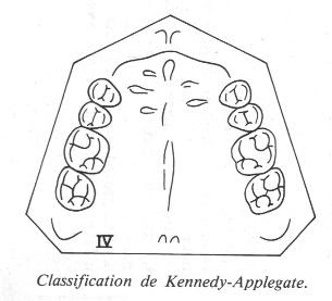 Classification des édentements