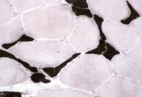 Health in Recovery : Alcoholic Myopathy