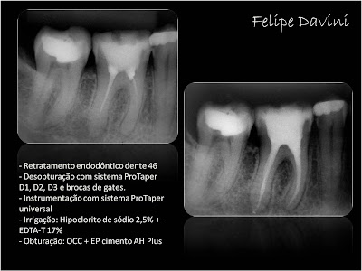 EQUIPE DE ENDODONTIA DE CAMPINAS: Caso Clínico - Retratamento do dente ...